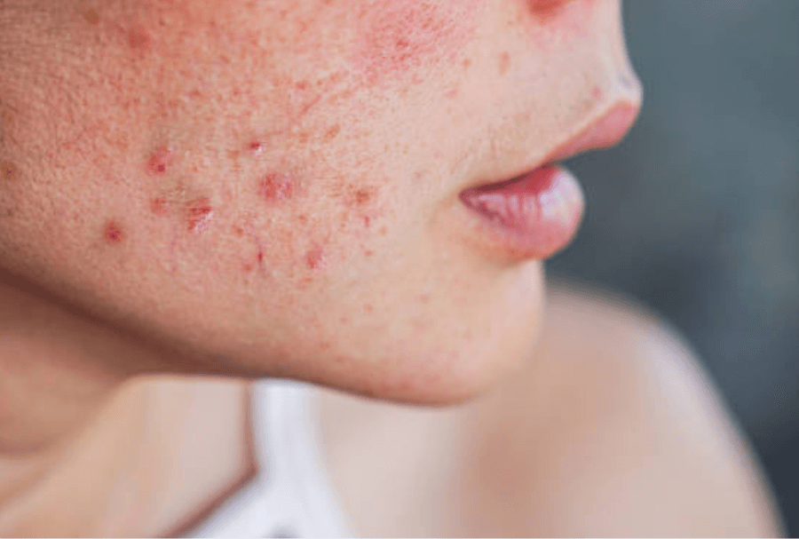 Δερματικά προβλήματα και διατροφή - Activeat